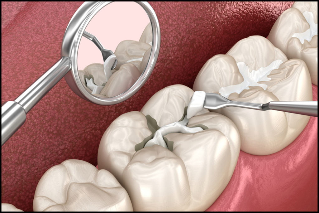 Carstairs Dental Bonding - Tooth Cavity Filling | Carstairs Dental